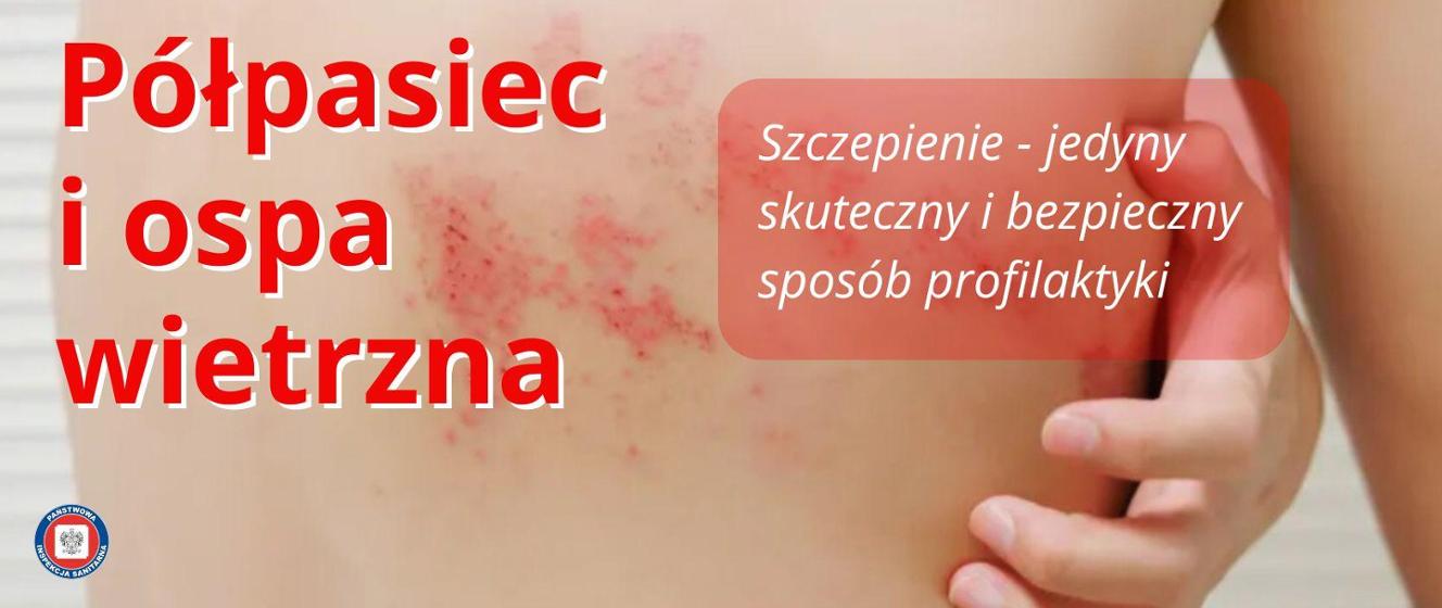 Półpasiec i ospa wietrzna - szczepienia profilaktyczne - Wojewódzka ...